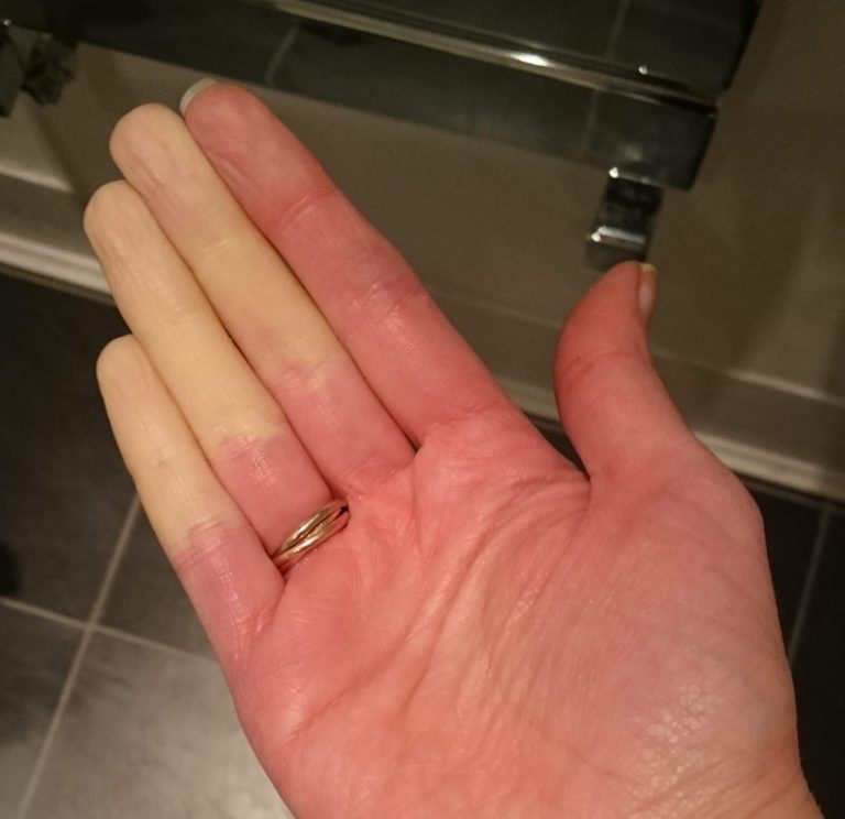 Raynaud’s: the ‘cold hand’ syndrome that affects one in six people ...